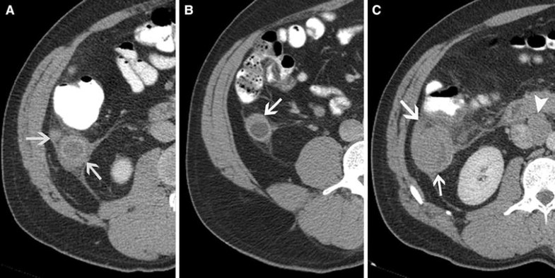 Beyond appendicitis; radiologic review of unusual and rare pathology of ...