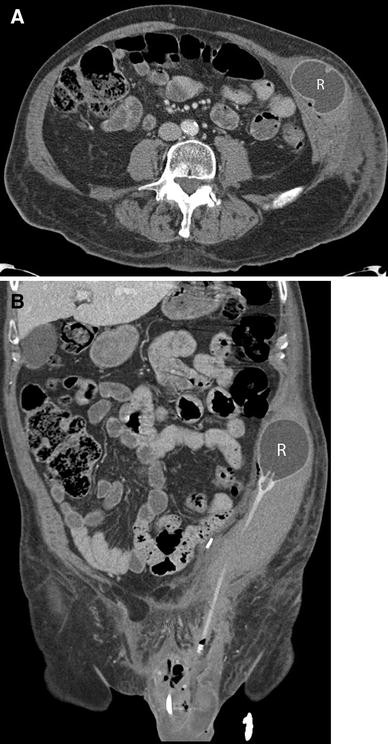 Inflatable penile prosthesis (IPP): diagnosis of complications ...