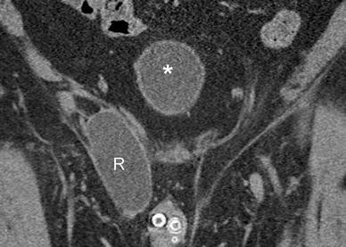 Inflatable penile prosthesis (IPP): diagnosis of complications ...