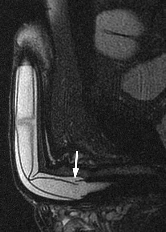 Inflatable penile prosthesis (IPP): diagnosis of complications ...