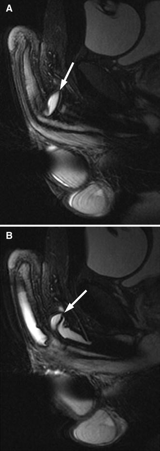 Inflatable penile prosthesis (IPP): diagnosis of complications ...