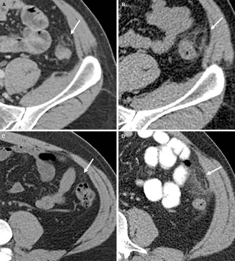 Radiology of epiploic appendages: acute appendagitis, post-infarcted ...