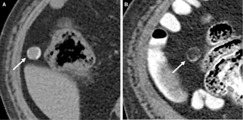 Radiology of epiploic appendages: acute appendagitis, post-infarcted ...