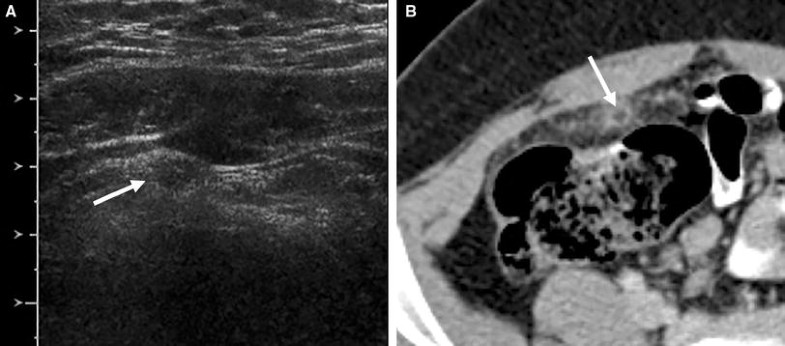Radiology of epiploic appendages: acute appendagitis, post-infarcted ...