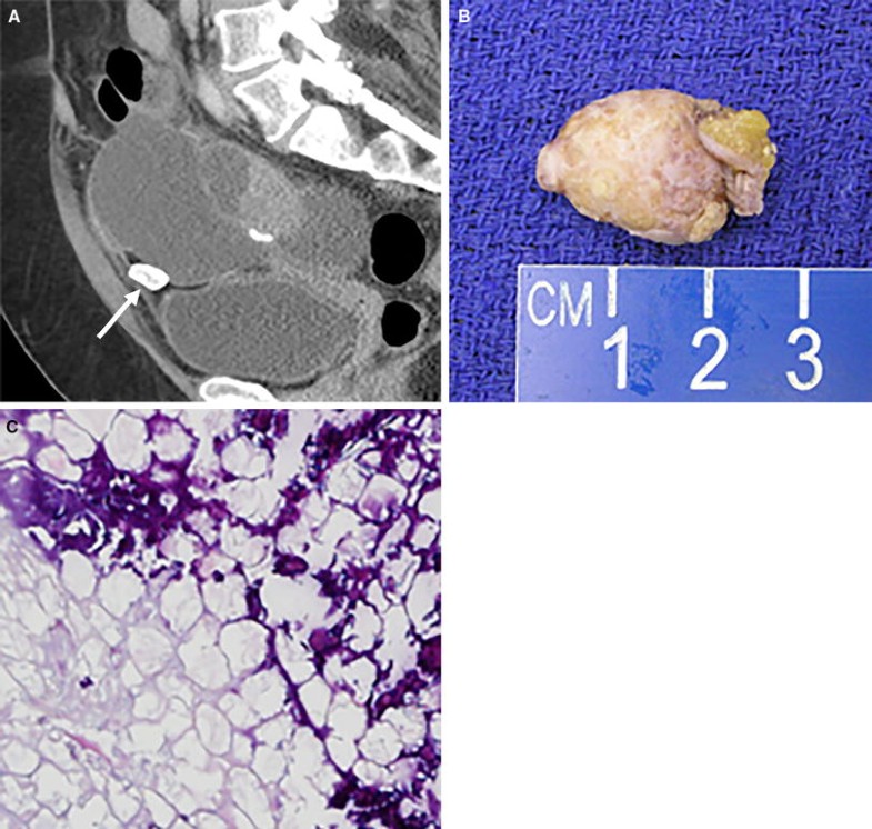 Radiology of epiploic appendages: acute appendagitis, post-infarcted ...