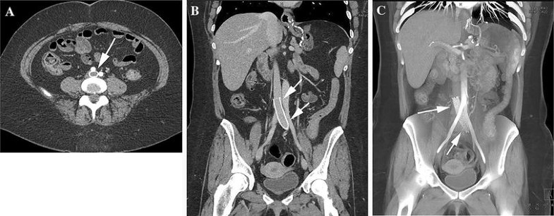May–Thurner syndrome: MDCT findings and clinical correlates | SpringerLink
