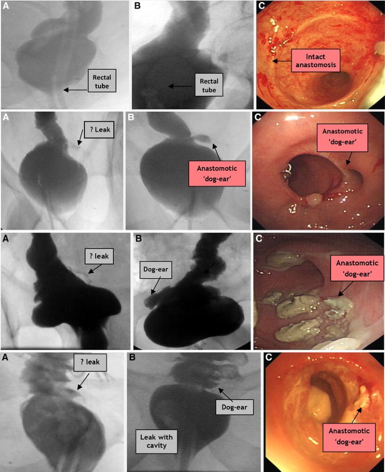 The novel appearance of low rectal anastomosis on contrast enema ...