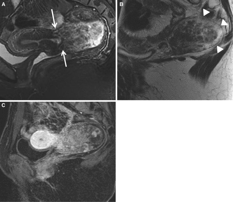 MR imaging of atypical fibroids | SpringerLink