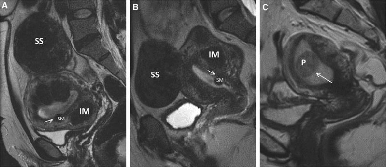 MR imaging of atypical fibroids | SpringerLink