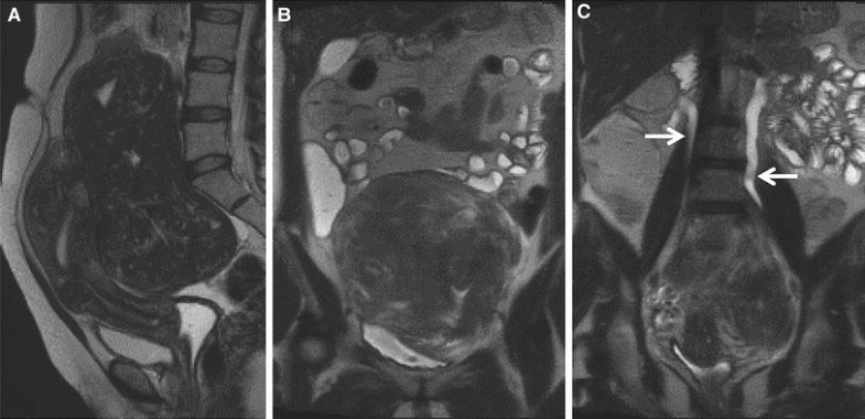 MR imaging of atypical fibroids | SpringerLink