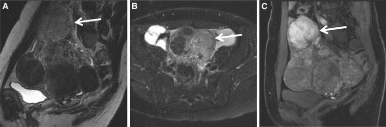 MR imaging of atypical fibroids | SpringerLink