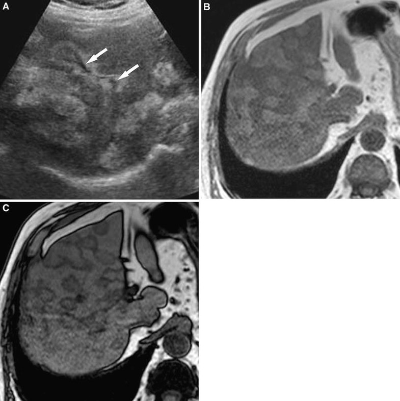 Focal fat deposition in the liver: diagnostic challenges on imaging ...