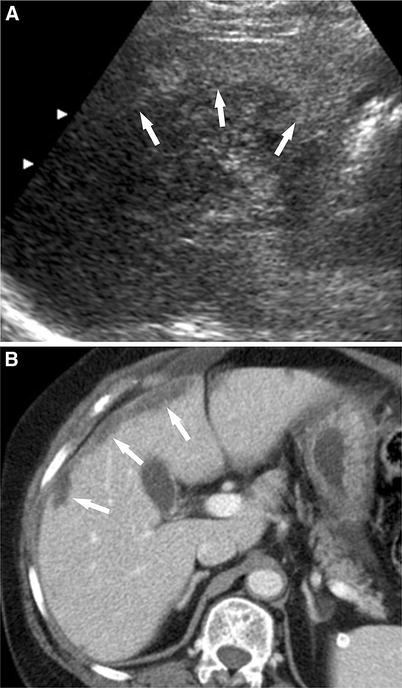 Focal fat deposition in the liver: diagnostic challenges on imaging ...