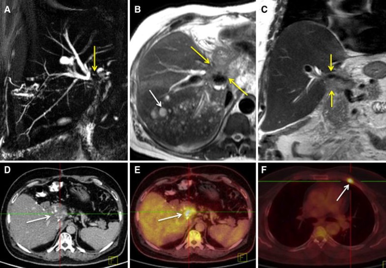 Cholangiocarcinoma: classification, diagnosis, staging, imaging features, and management ...
