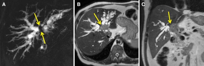 Cholangiocarcinoma: classification, diagnosis, staging, imaging ...