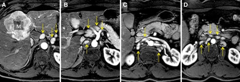 Cholangiocarcinoma: classification, diagnosis, staging, imaging features, and management ...