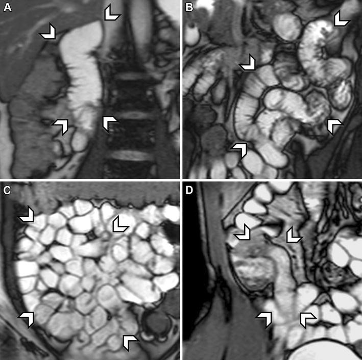 Shortened oral contrast preparation for improved small bowel distension ...