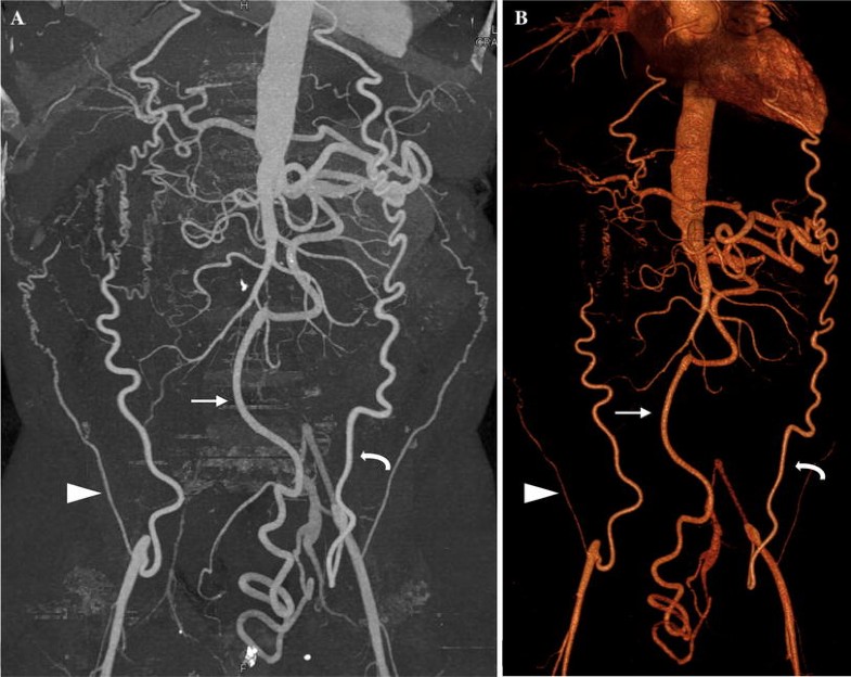 CT angiography and 3D imaging in aortoiliac occlusive disease ...