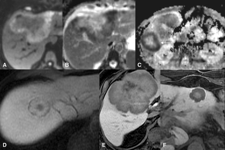 LI-RADS M (LR-M): definite or probable malignancy, not specific for ...
