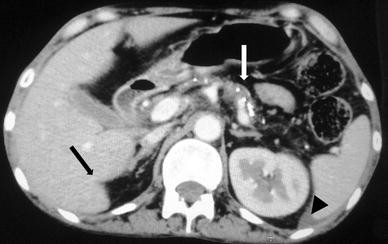 Right posterior hepatic notch sign | SpringerLink