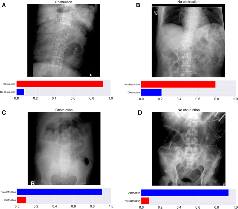 Detection of high-grade small bowel obstruction on conventional ...