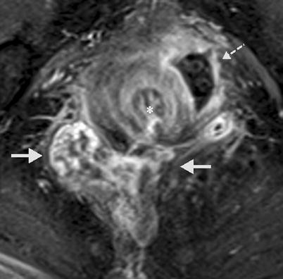 MRI of anal canal: normal anatomy, imaging protocol, and perianal ...