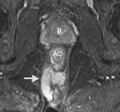 MRI of anal canal: normal anatomy, imaging protocol, and perianal ...