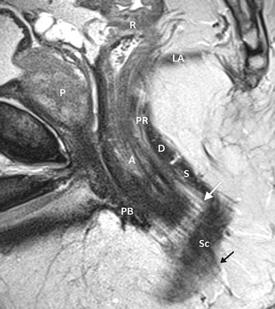 MRI of anal canal: normal anatomy, imaging protocol, and perianal ...