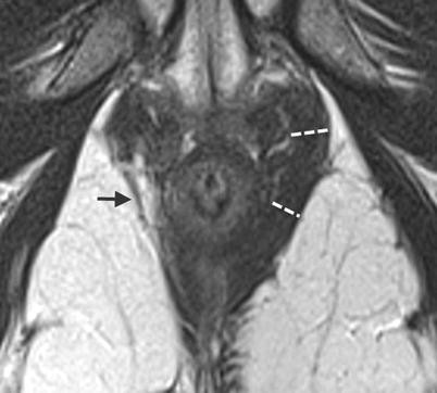 MRI of anal canal: normal anatomy, imaging protocol, and perianal ...