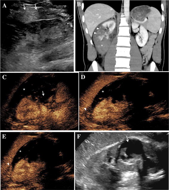 Applications of contrast-enhanced ultrasound in the pediatric abdomen ...