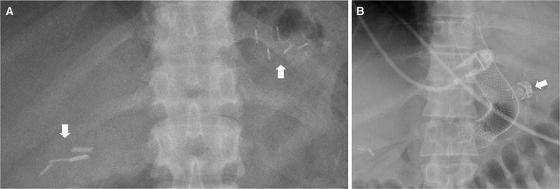What the radiologist needs to know about gastrointestinal endoscopic ...