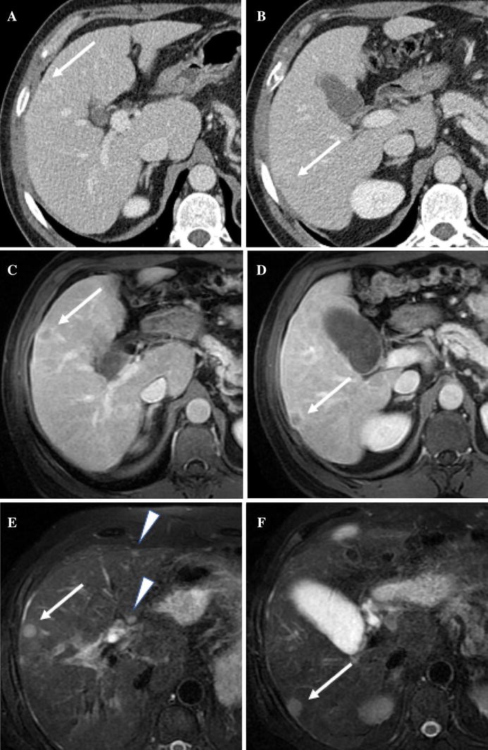 Staging of pancreatic cancer: resectable, borderline resectable, and ...