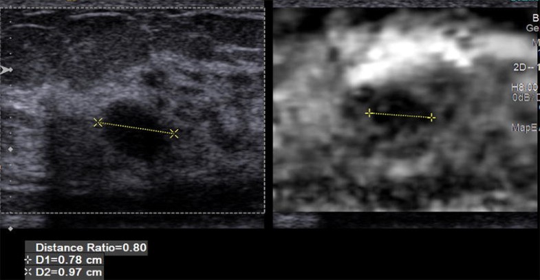 Principles of ultrasound elastography | SpringerLink