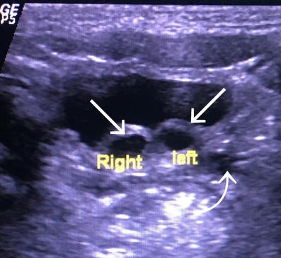 The “cyst within cyst” sign of intravesical ureterocele | SpringerLink