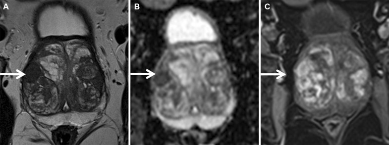 False positives in PIRADS (V2) 3, 4, and 5 lesions: relationship with ...