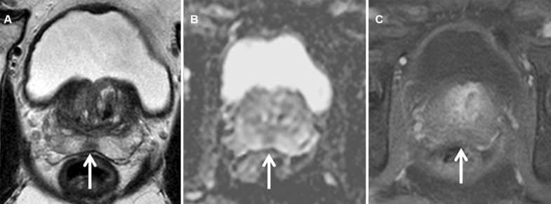 False positives in PIRADS (V2) 3, 4, and 5 lesions: relationship with ...