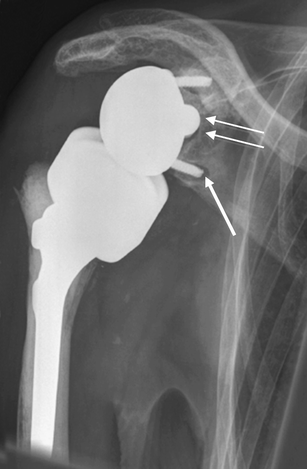 Reverse total shoulder arthroplasty—from the most to the least common ...