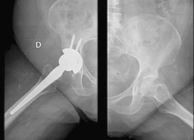 Total hip replacement with an uncemented Wagner cone stem for patients ...