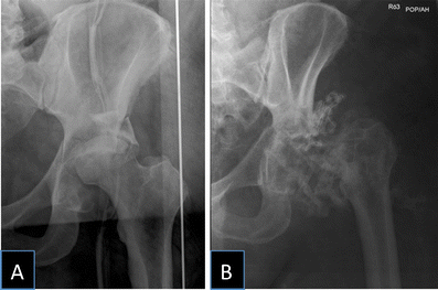 Surgical therapy of hip-joint empyema. Is the Girdlestone arthroplasty ...