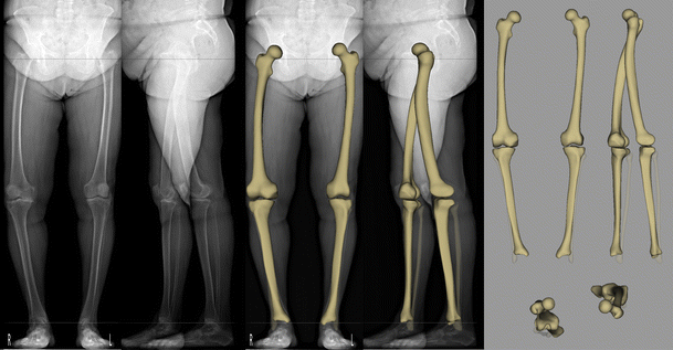 The EOS™ imaging system and its uses in daily orthopaedic practice ...