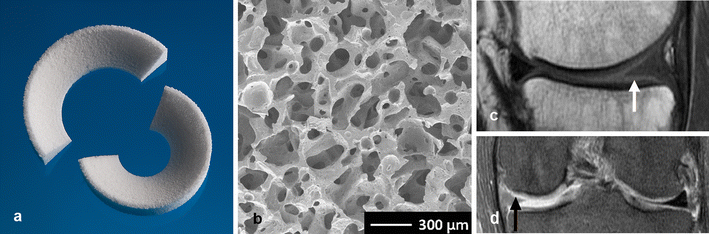 Synthetic meniscus replacement: a review | SpringerLink