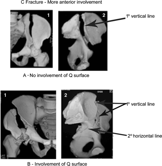 The study of broken quadrilateral surface in fractures of the ...