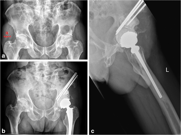 The modified Harrington procedure for metastatic peri-acetabular bone ...