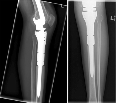 Early follow-up of a custom non-fluted diaphyseal press-fit tumour ...