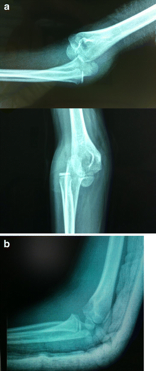 The role of simple elbow dislocations in cubitus valgus development in ...