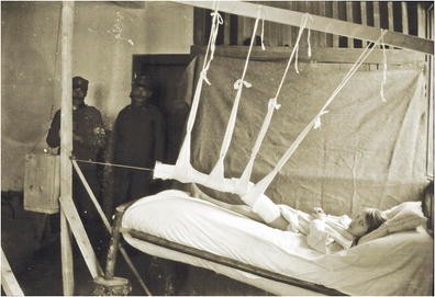 The Balkan beam – Florschütz frame and its use during the Great War ...