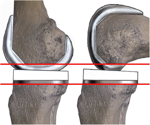 Influence of tibial slope on extension and flexion gaps in total knee ...
