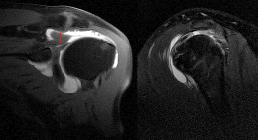 Massive rotator cuff tears: definition and treatment | SpringerLink