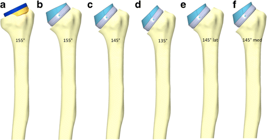 Effect of humeral stem design on humeral position and range of motion ...