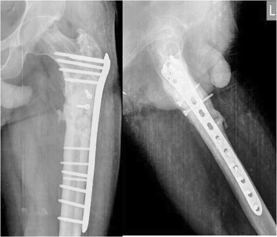 Reversed distal femoral locking plate for failed proximal femoral nail ...